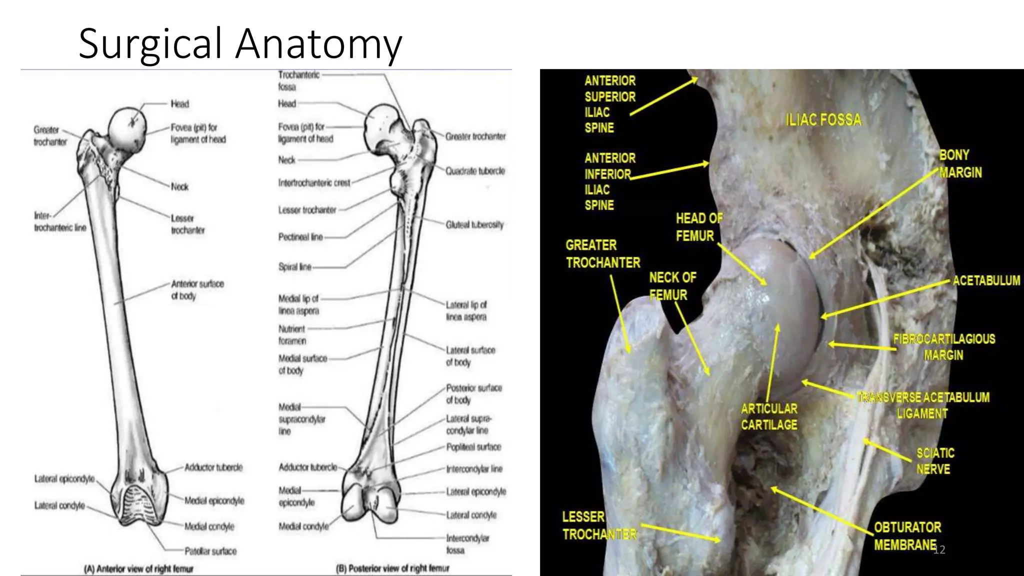 management of neck of femur fracture | PPTX