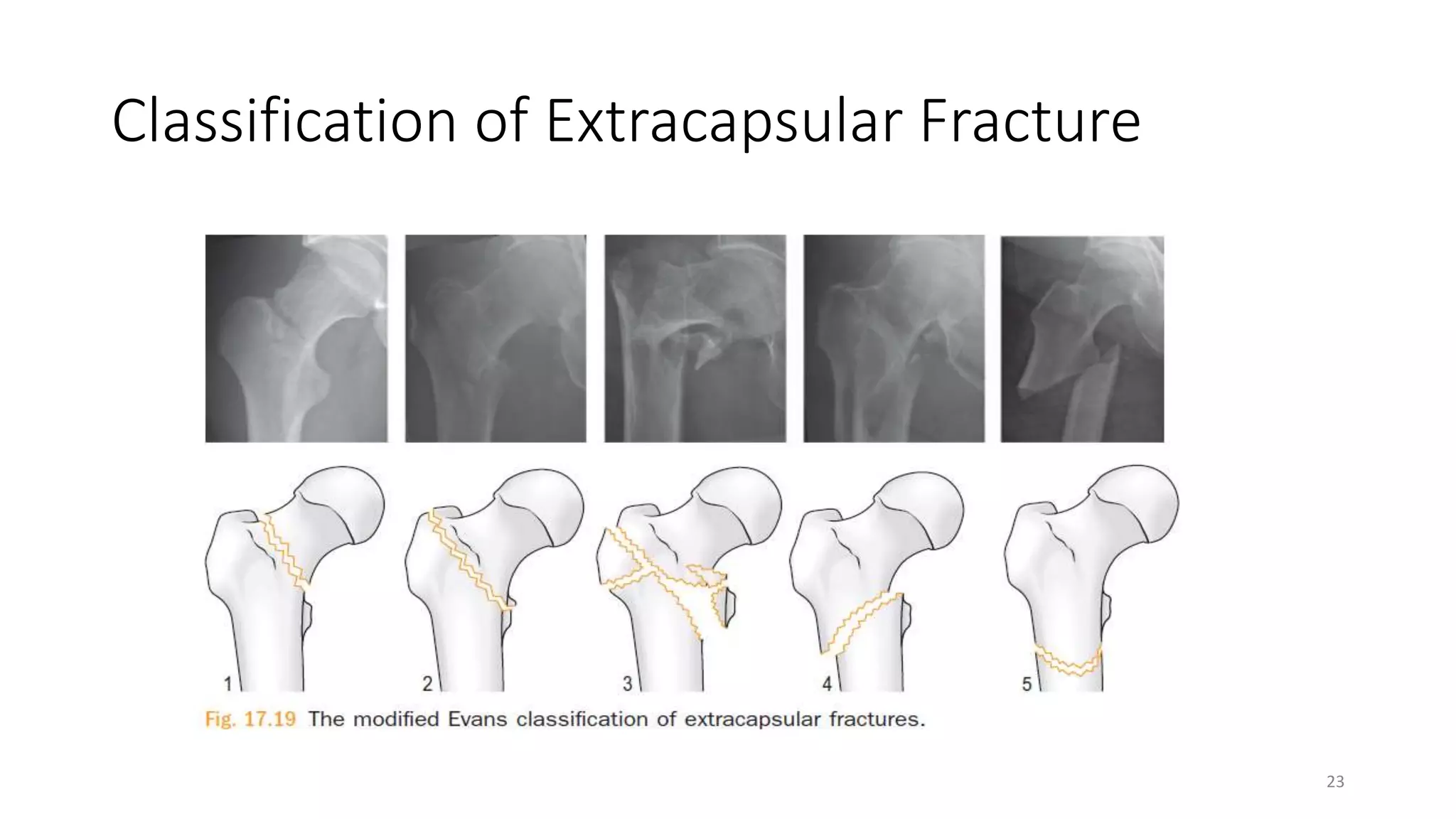 management of neck of femur fracture | PPTX