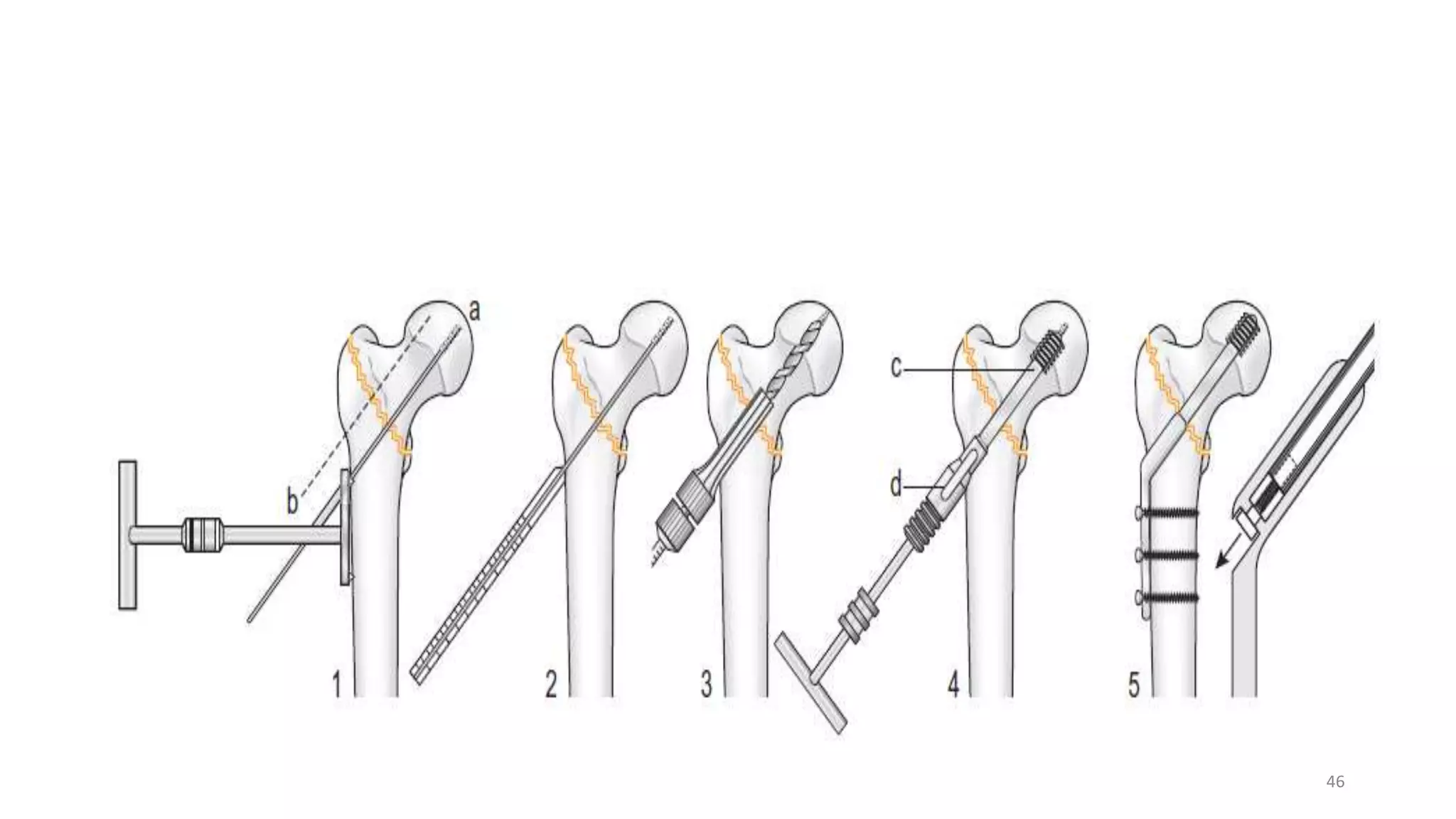 management of neck of femur fracture | PPTX