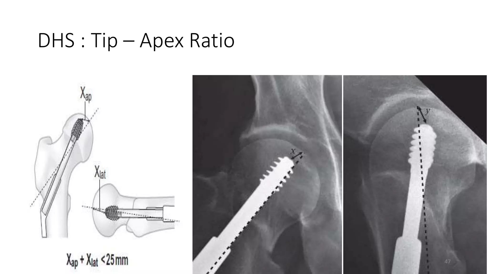 management of neck of femur fracture | PPTX