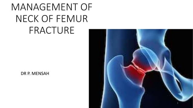 management of neck of femur fracture | PPTX