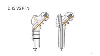 management of neck of femur fracture | PPT
