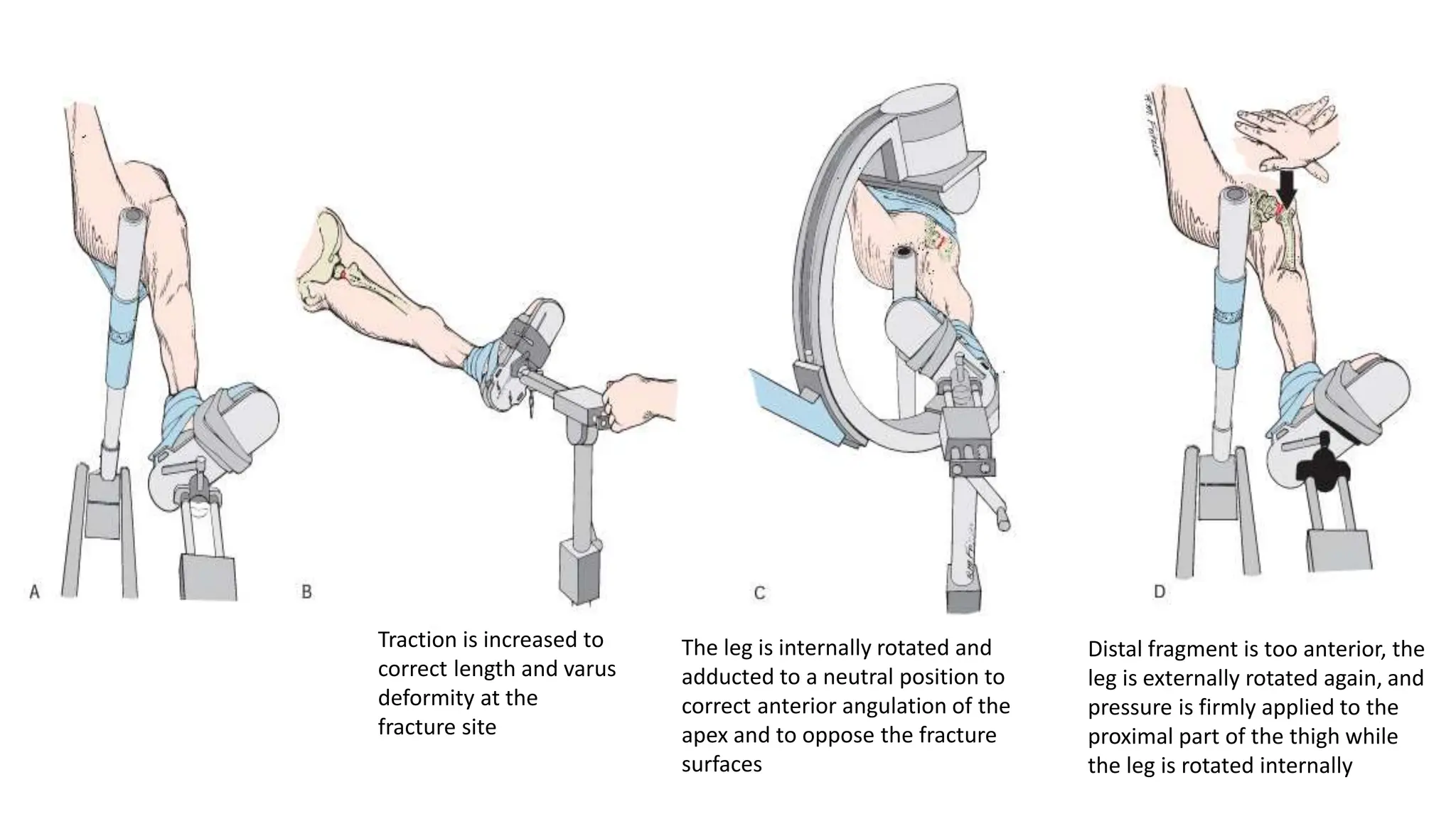 NECK OF FEMUR FRACTURE ORTHOPAEDICS.pptx