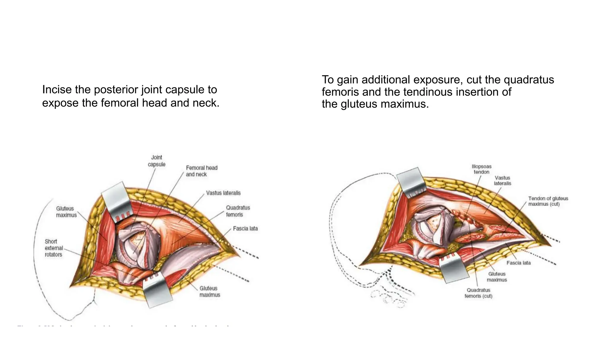 NECK OF FEMUR FRACTURE ORTHOPAEDICS.pptx