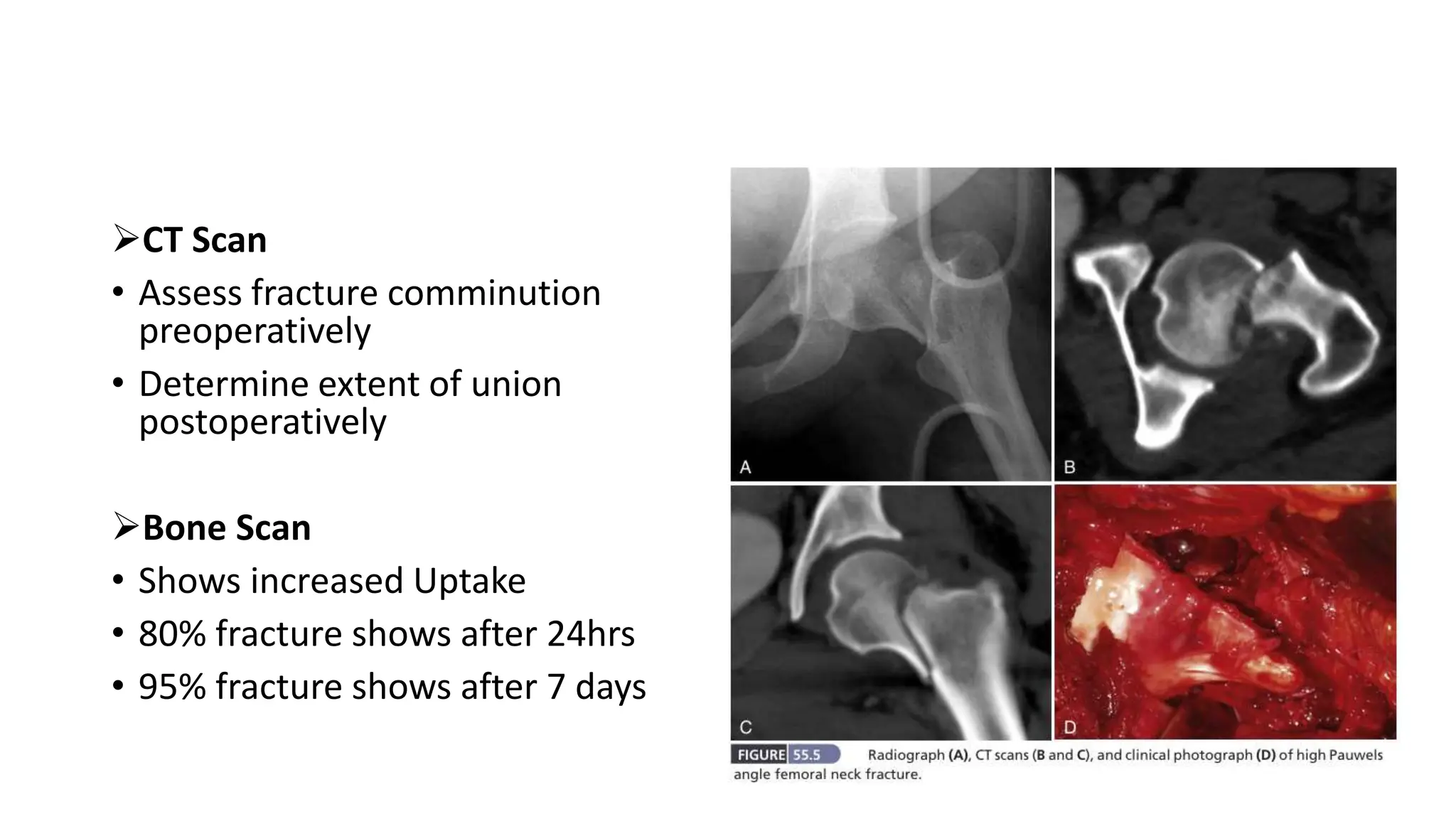 NECK OF FEMUR FRACTURE ORTHOPAEDICS.pptx