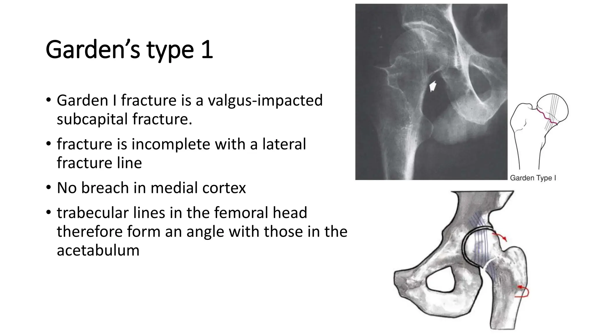 NECK OF FEMUR FRACTURE ORTHOPAEDICS.pptx
