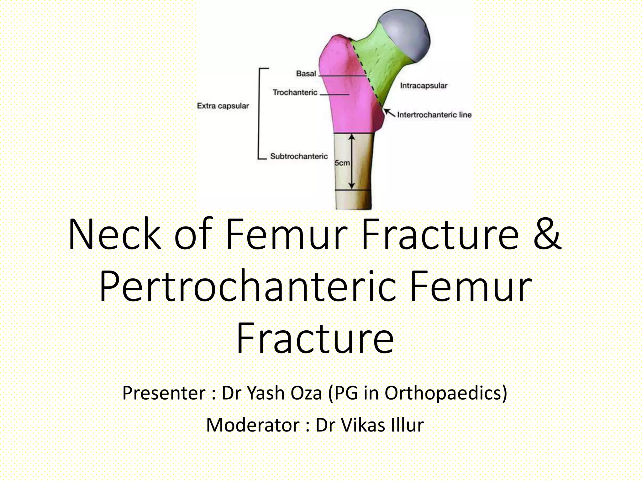 Neck of femur fracture & Trochanteric femur fracture | PPTX