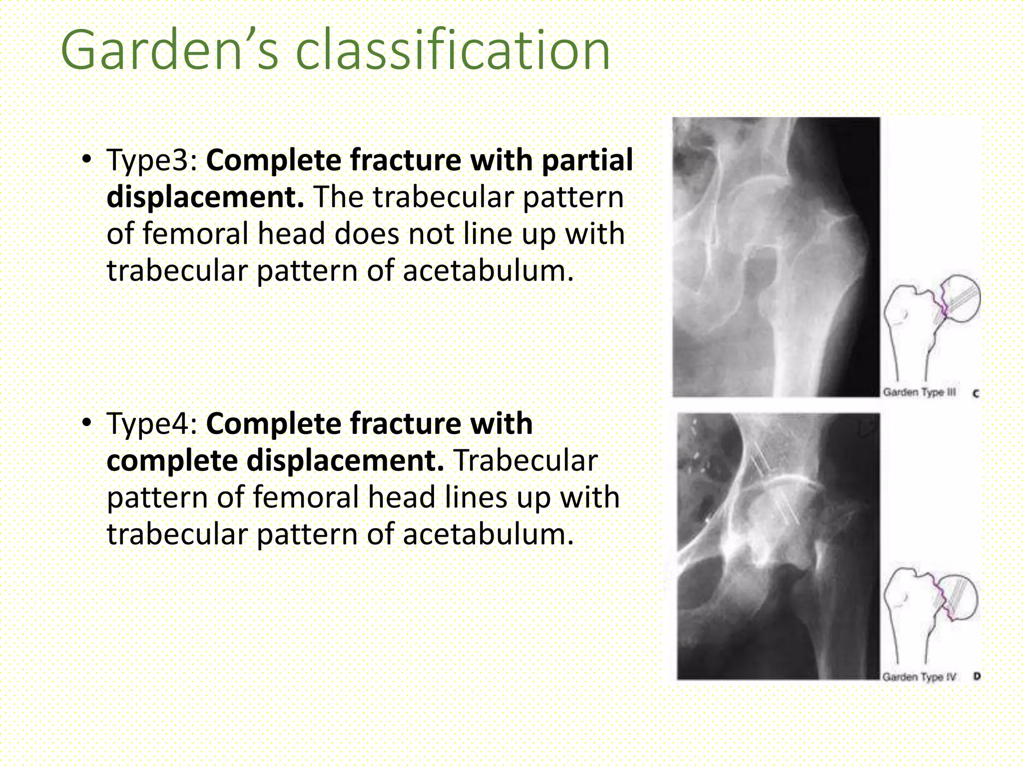 Neck of femur fracture & Trochanteric femur fracture | PPTX