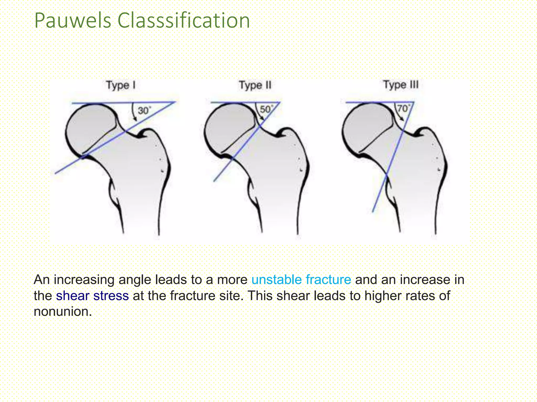 Neck of femur fracture & Trochanteric femur fracture | PPTX