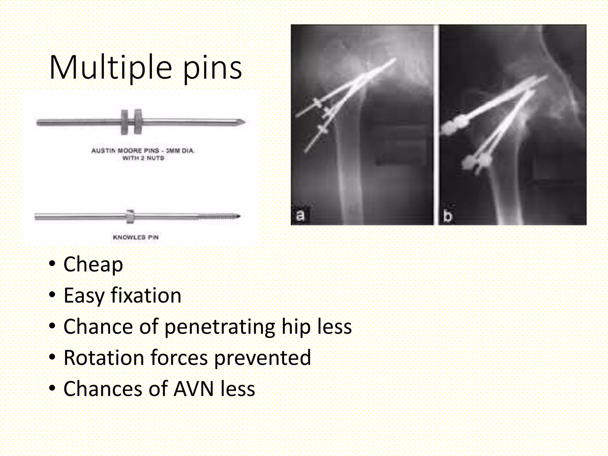 Neck of femur fracture & Trochanteric femur fracture | PPTX