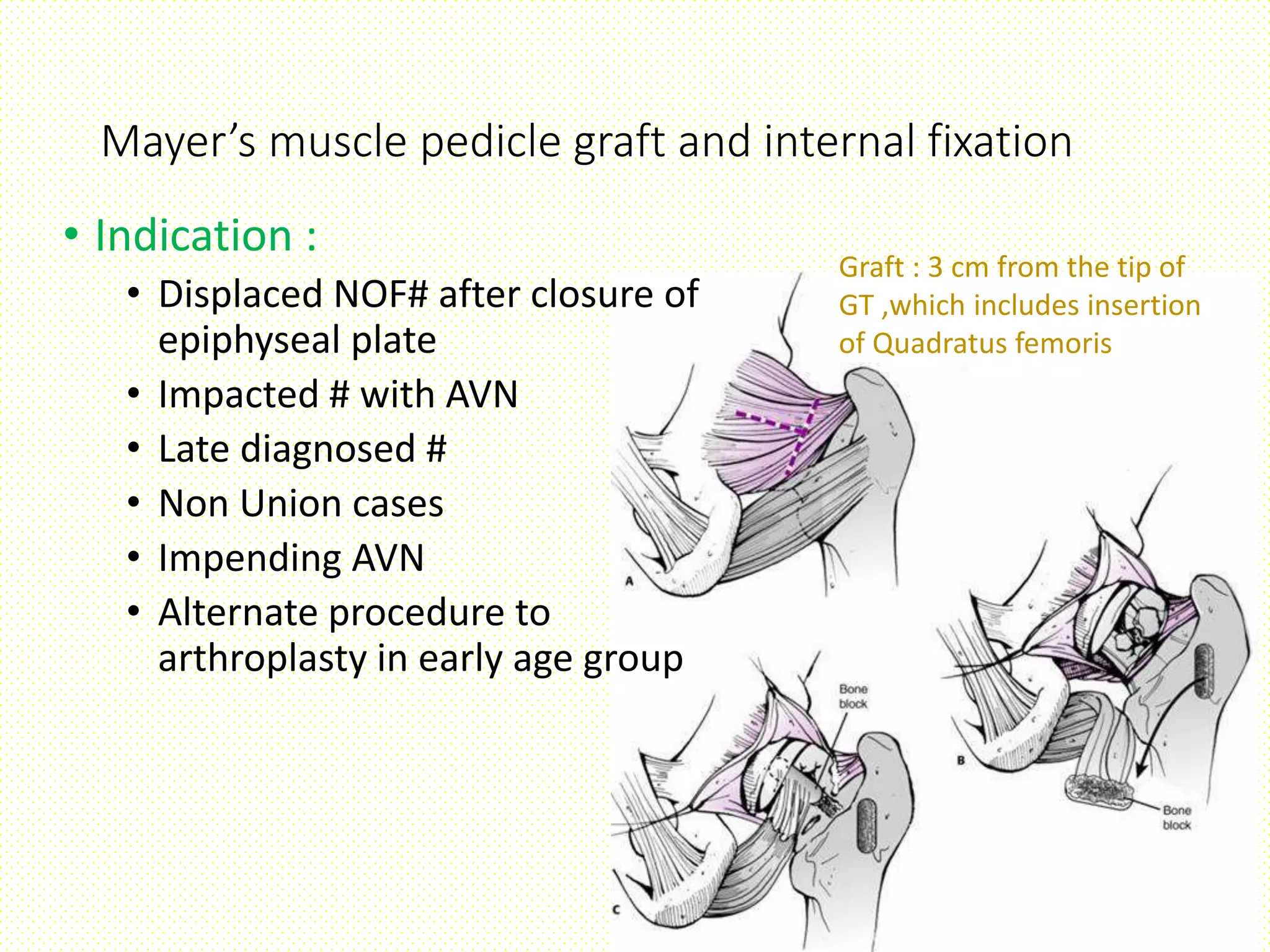 Neck of femur fracture & Trochanteric femur fracture | PPTX