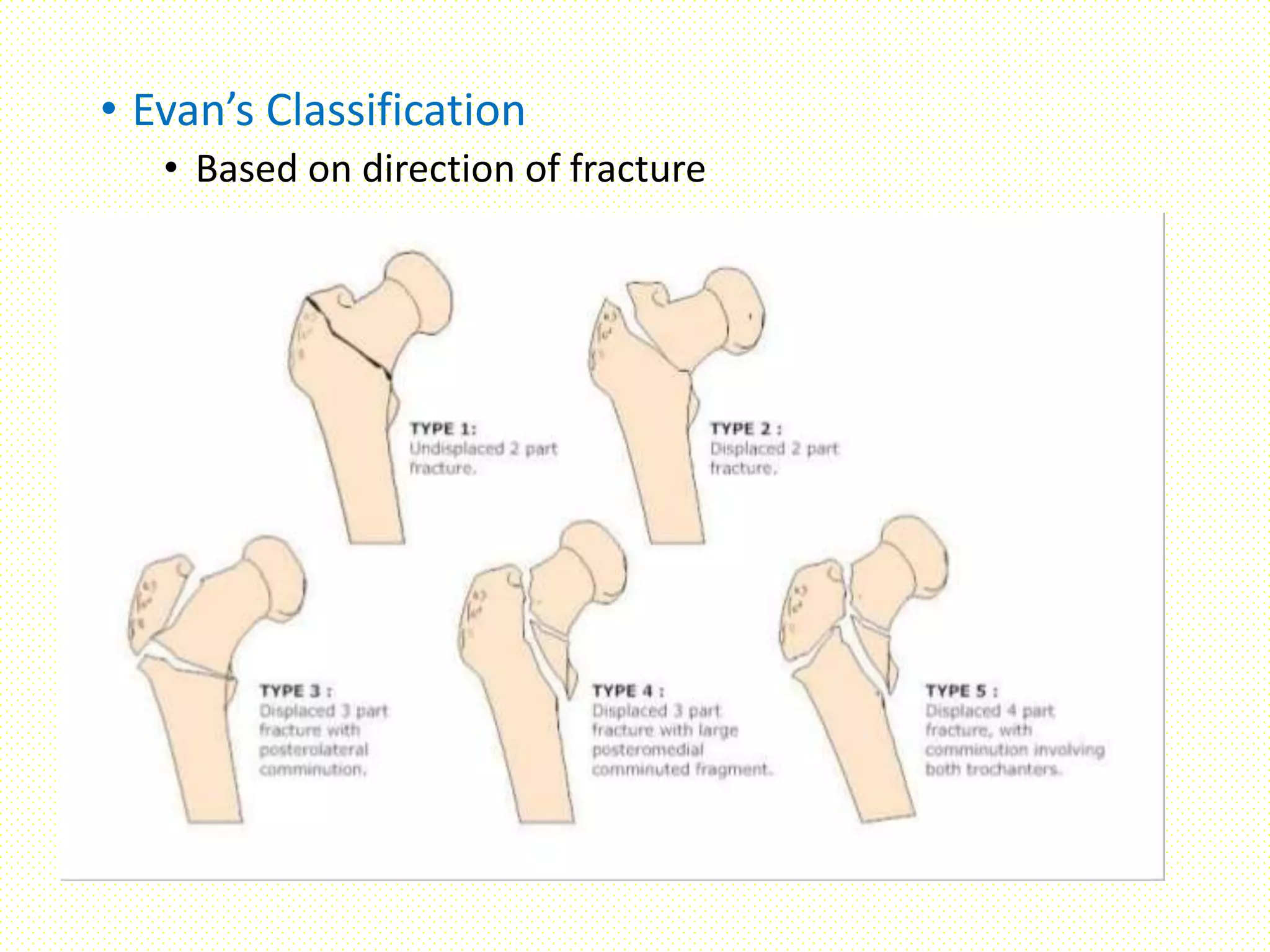 Neck of femur fracture & Trochanteric femur fracture | PPTX