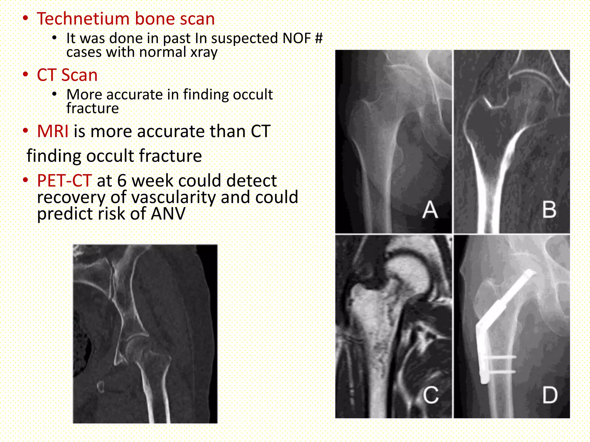 Neck of femur fracture & Trochanteric femur fracture | PPTX