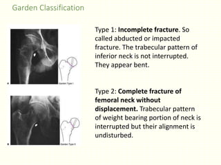 Garden classification of femoral neck fractures.