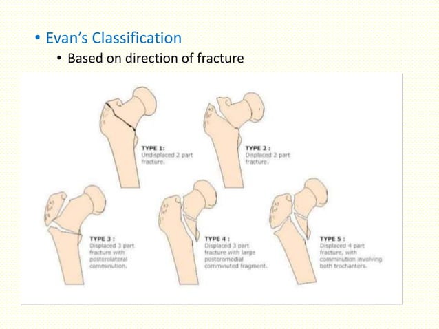 Neck of femur fracture & Trochanteric femur fracture | PPTX | Bone and ...