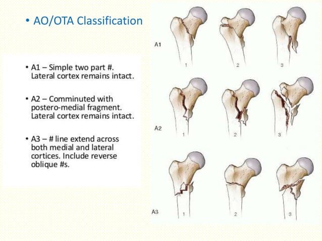 Neck of femur fracture & Trochanteric femur fracture | PPTX | Bone and ...