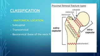 Neck of femur fracture | PPTX | Death, Injury, or Military Conflict ...