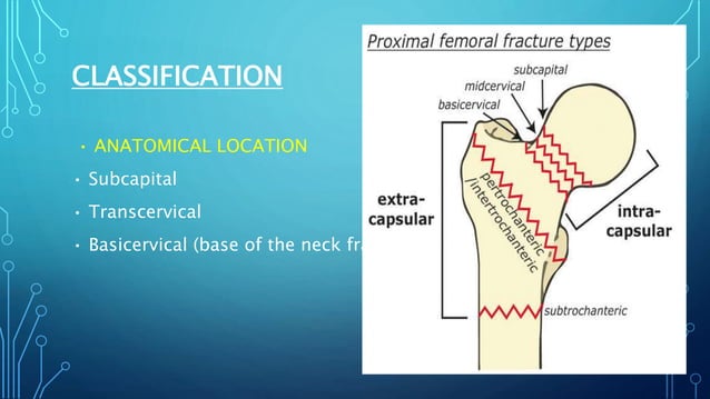 Neck of femur fracture | PPT