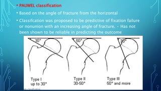 Neck of femur fracture | PPTX | Death, Injury, or Military Conflict ...