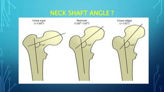 Neck of femur fracture | PPTX