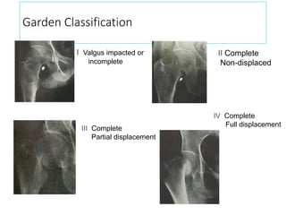 Neck Of femur fracture.pptx