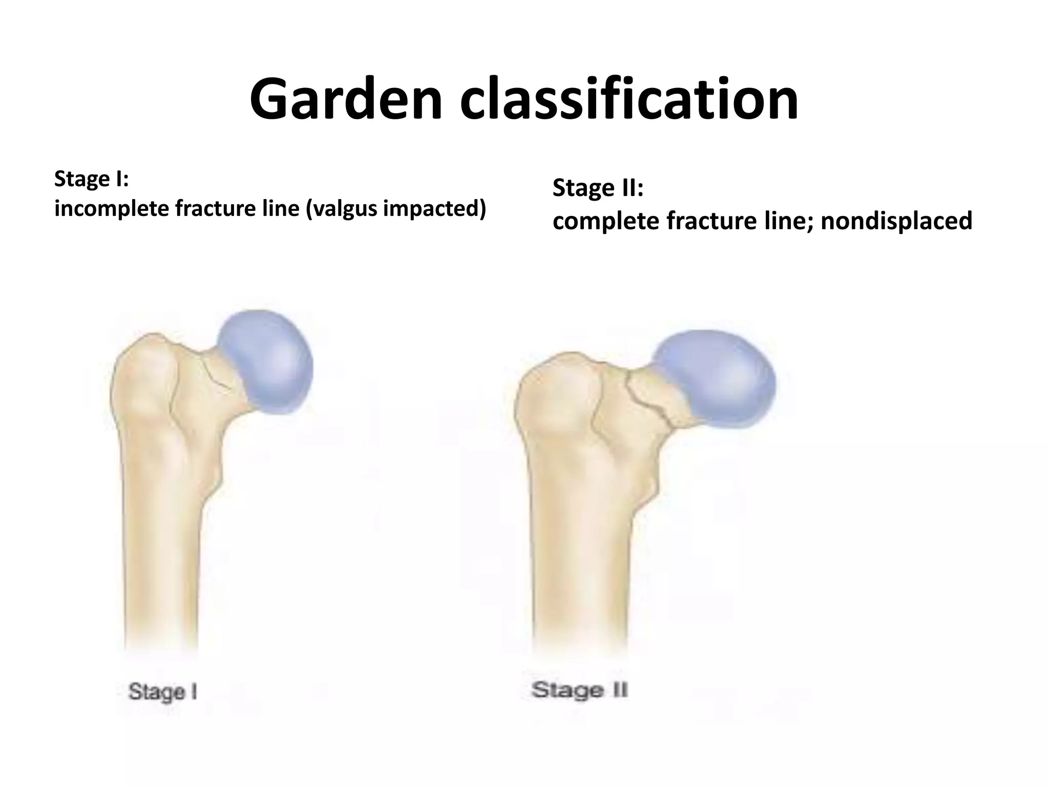 Neck of femur fractures | PPTX