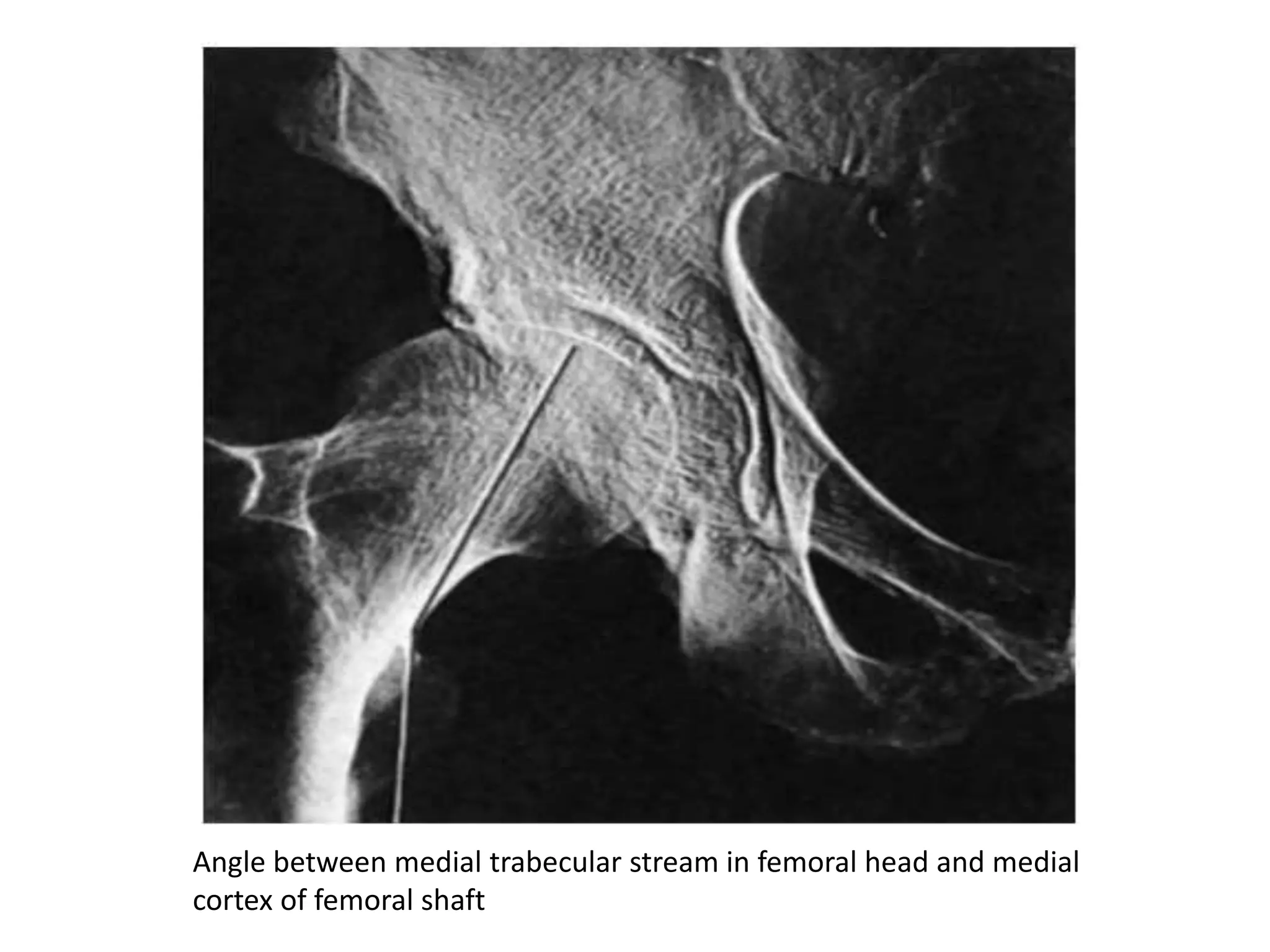 Neck of femur fractures | PPTX