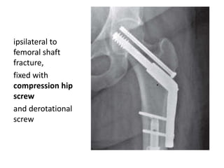 Neck of femur fractures | PPTX