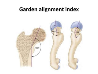 Neck of femur fractures | PPT