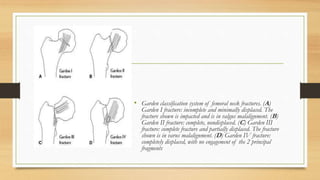 Neck of femur fractures (2) | PPT