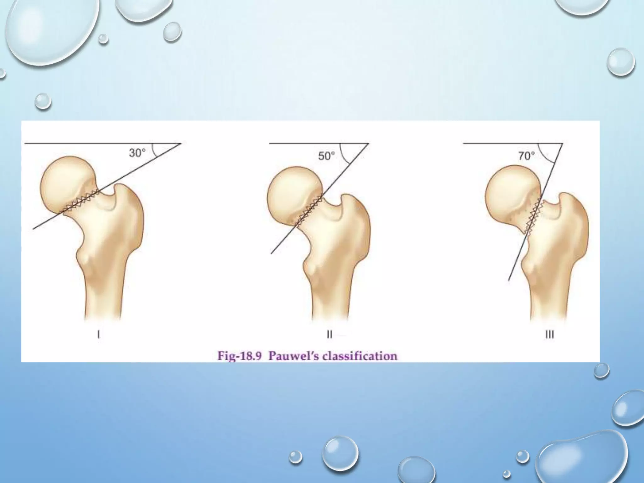 Neck of Femur, IT and Subtrochanteric fracture- Dr Sundar Ortho.pptx