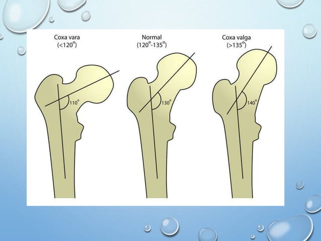 Neck of Femur, IT and Subtrochanteric fracture- Dr Sundar Ortho.pptx