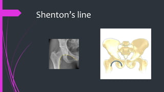 Neck of the femur fracture | PPTX