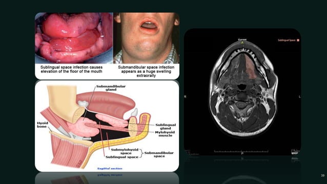 Neck space infections taken from PL. DHINGRA and other sources to cover ...