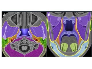 Radiological Anatomy of Neck Spaces with their clinical significance | PPTX