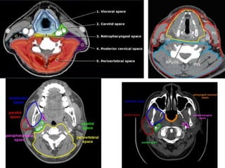 Radiological Anatomy of Neck Spaces with their clinical significance | PPTX