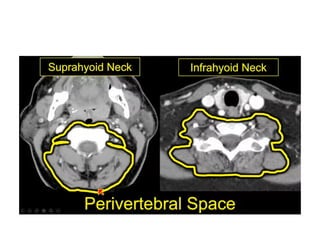Radiological Anatomy of Neck Spaces with their clinical significance | PPTX