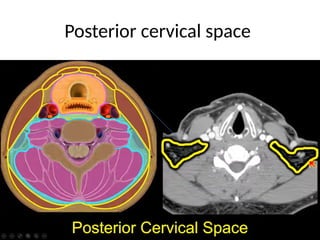 Radiological Anatomy of Neck Spaces with their clinical significance | PPTX