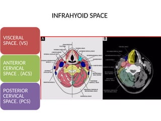 Radiological Anatomy of Neck Spaces with their clinical significance | PPTX