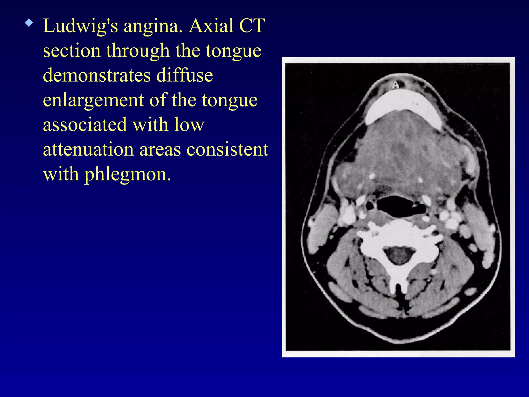 Neck spaces anatomy and infections | PPT