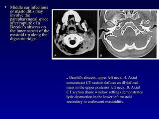 Neck spaces anatomy and infections | PPT