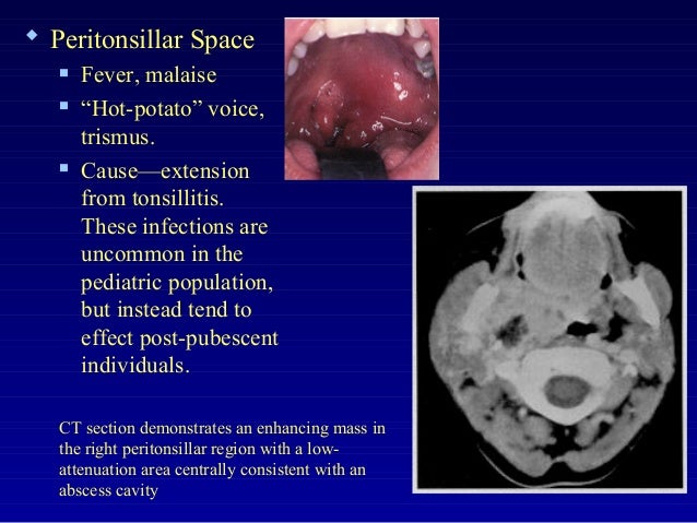 Neck spaces anatomy and infections