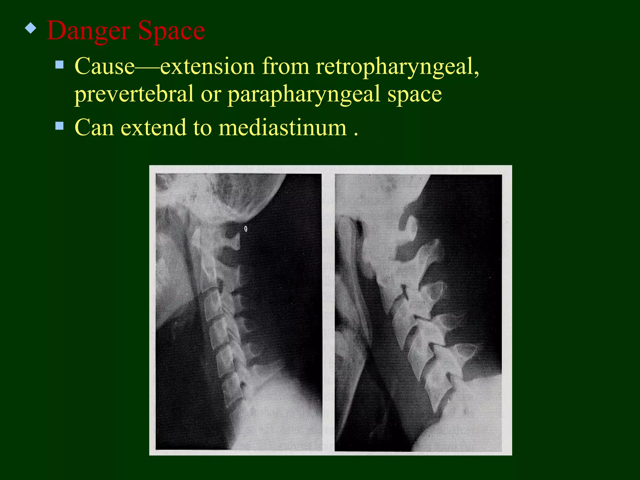 Neck spaces and mediastinum | PPT