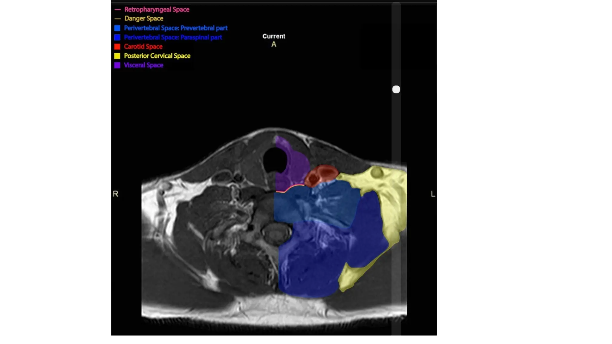 Deep neck spaces and muscles of neck- Radiology | PPTX