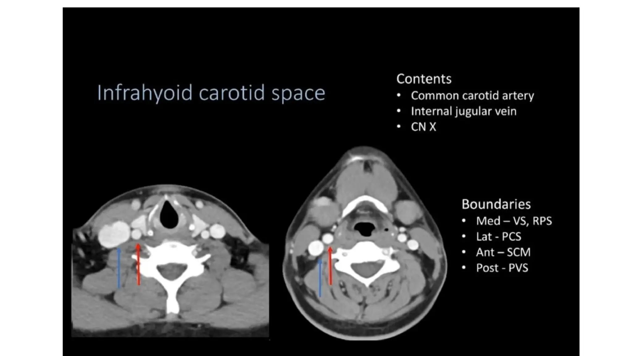 Deep neck spaces and muscles of neck- Radiology | PPTX