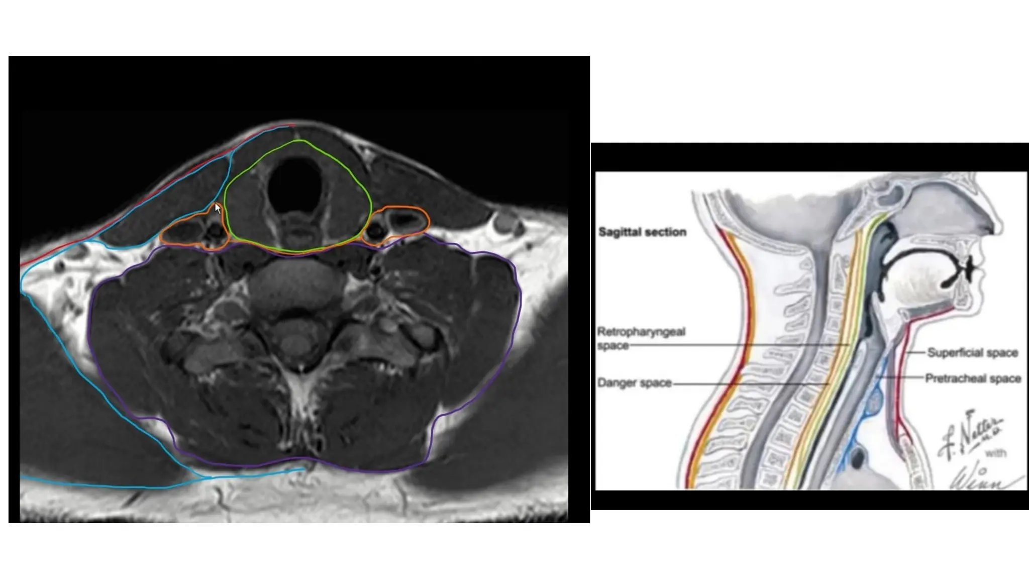 Deep neck spaces and muscles of neck- Radiology | PPTX