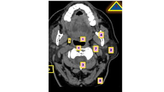 Deep neck spaces and muscles of neck- Radiology | PPTX