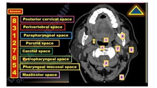 Deep neck spaces and muscles of neck- Radiology | PPTX