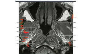 Deep neck spaces and muscles of neck- Radiology | PPTX
