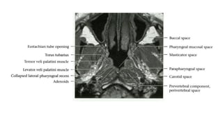 Deep neck spaces and muscles of neck- Radiology | PPTX